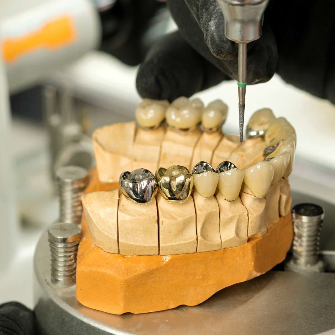 Dental Crowns in Hyderabad : Cost | Steps | Recovery - Kosmo Dental Clinic